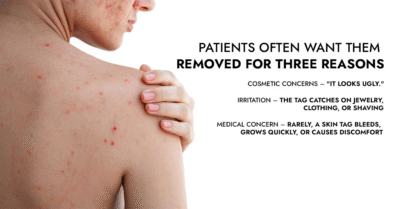 ICD-10 Codes for Skin Tags: Billable vs Non-Billable 2025